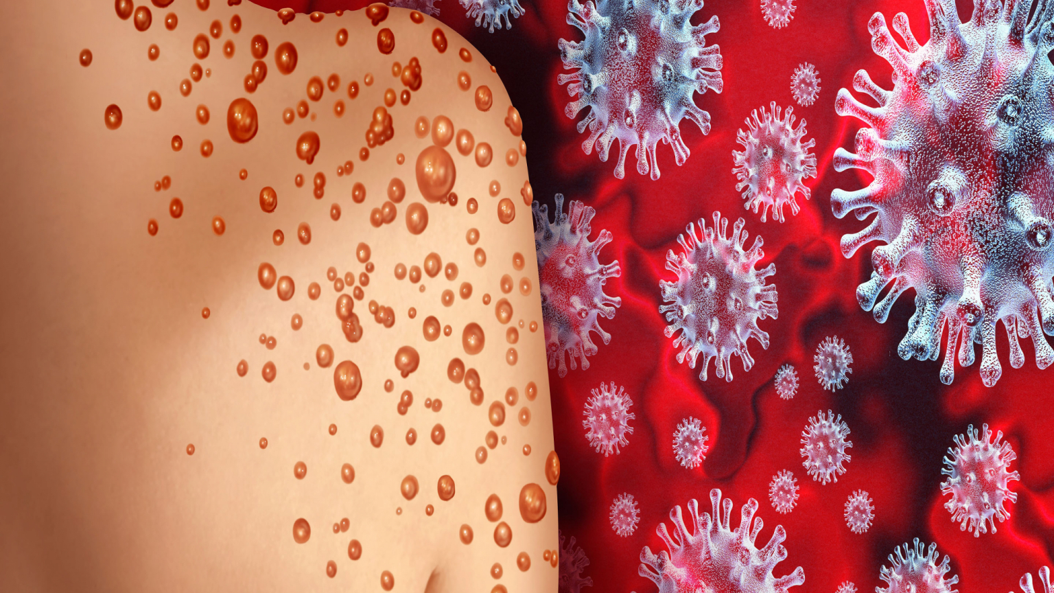 Monkeypox: Normal Precautions — But No Special Precautions — Are Needed ...